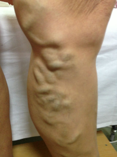 Varis Nedir? - Varis Tedavileri