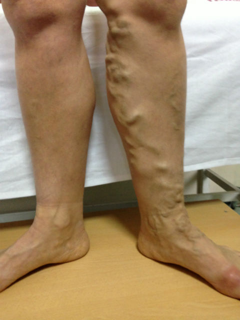 Varis Nedir? - Varis Tedavileri